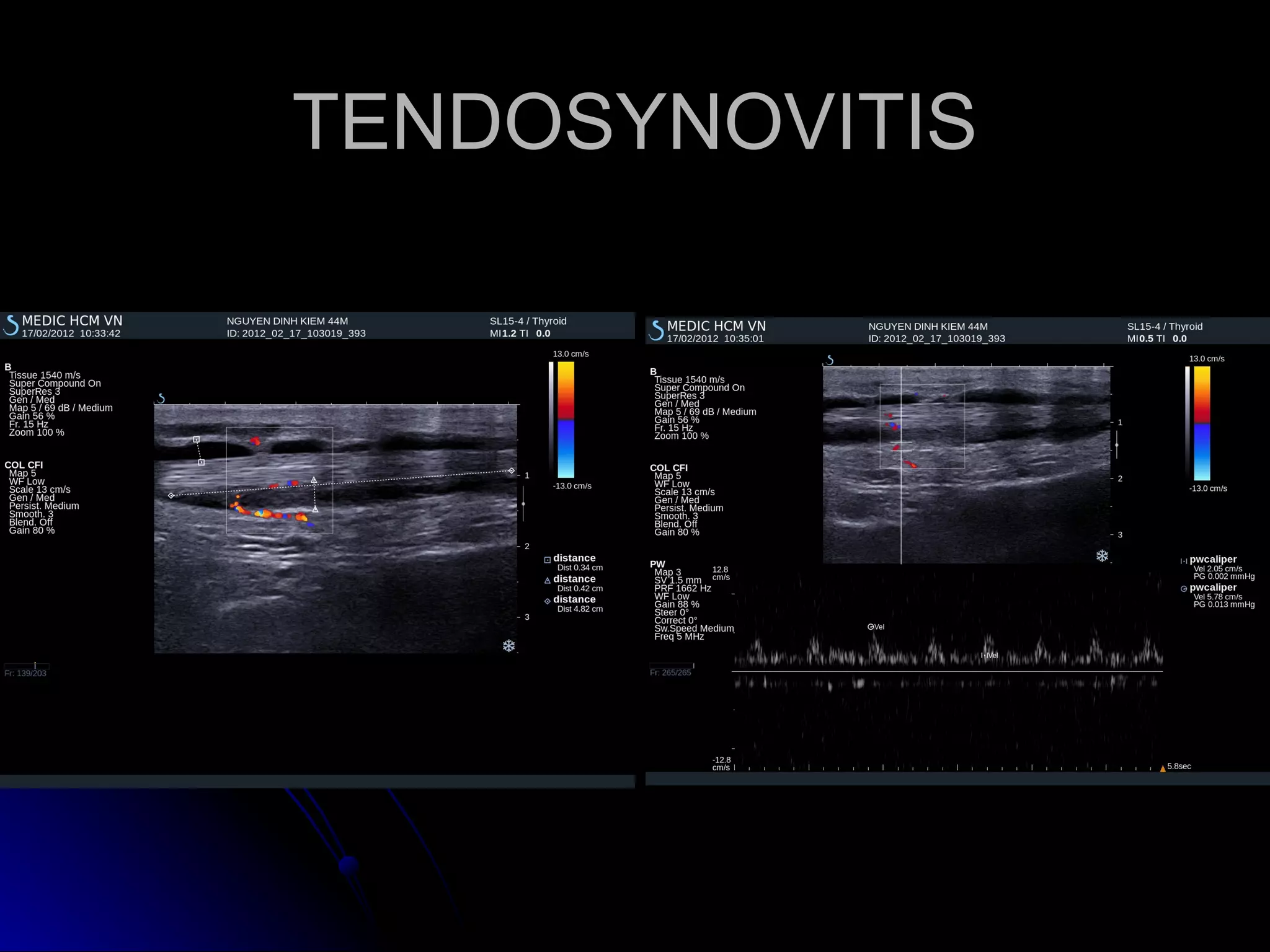 Musculoskeletal Applications of Supersonic Shear Imaging (SSI) | PPT ...