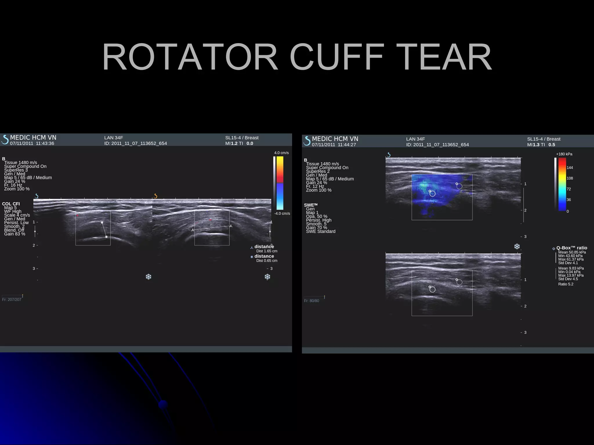 Musculoskeletal Applications of Supersonic Shear Imaging (SSI) | PPT ...