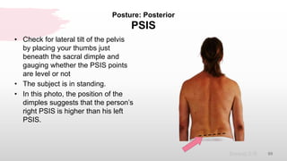 Posterior Superior Iliac Spine Dimples