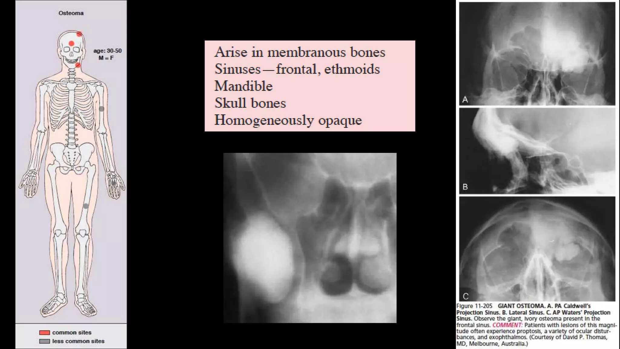 Imaging of benign bone tumors | PPTX