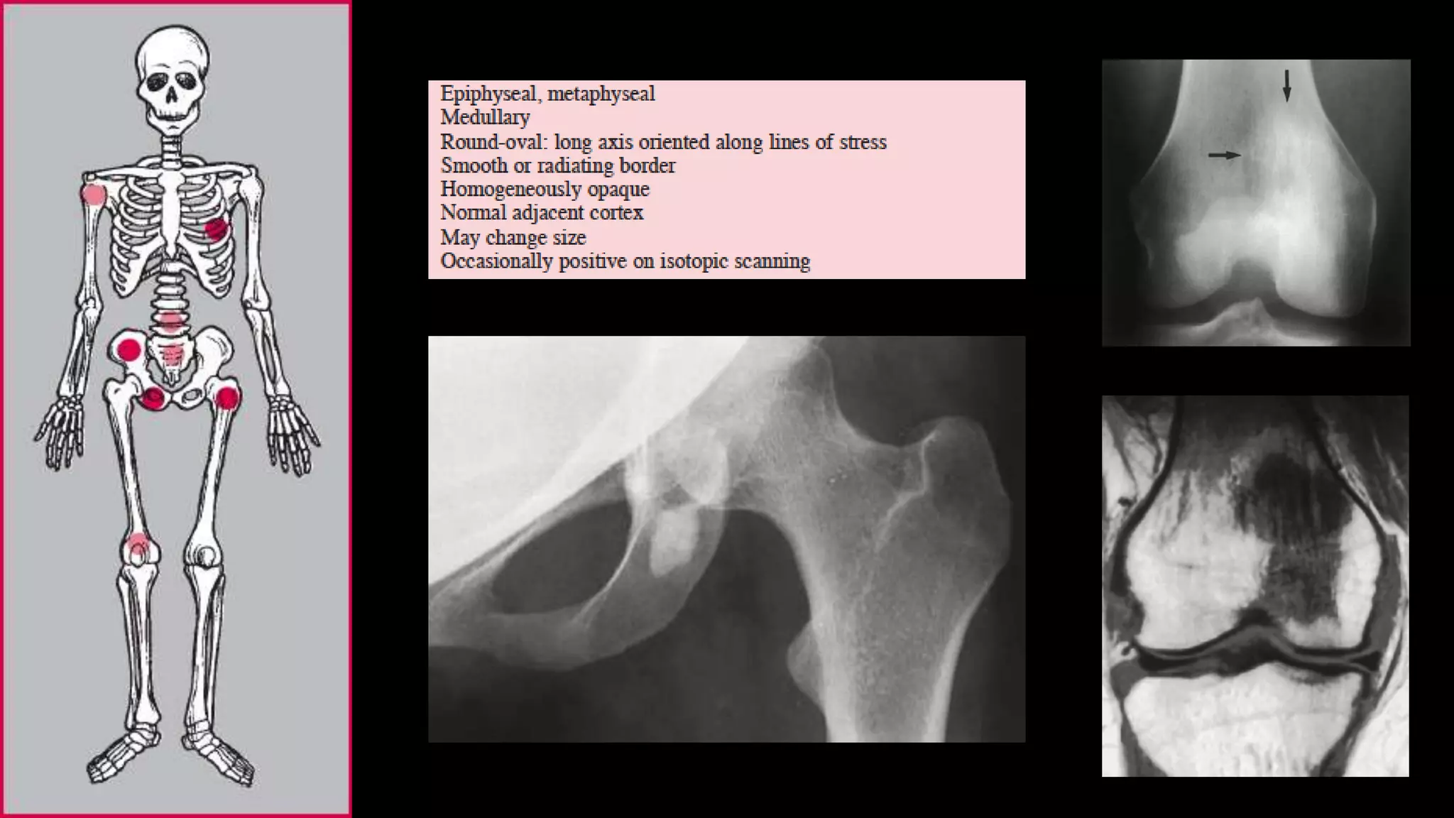Imaging of benign bone tumors | PPTX