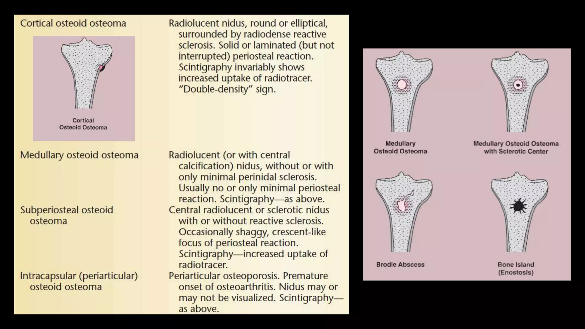 Imaging of benign bone tumors | PPTX