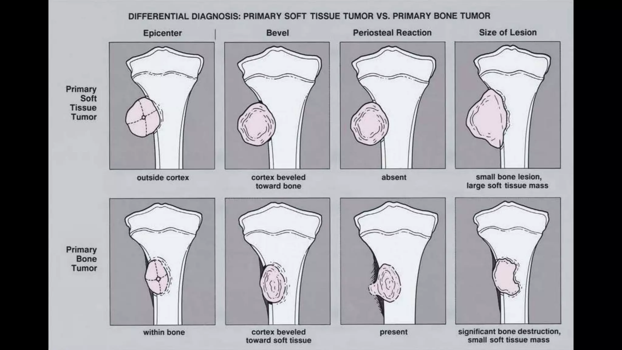 Imaging of benign bone tumors | PPTX