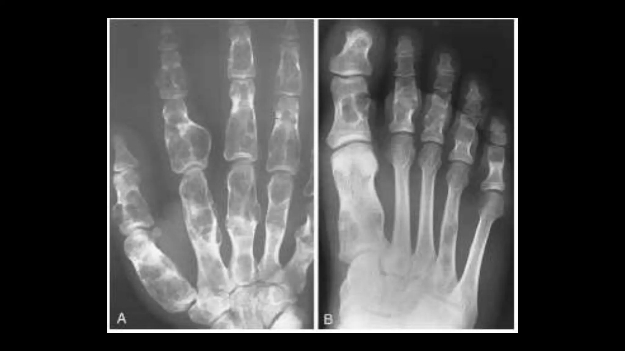 Imaging of benign bone tumors | PPTX