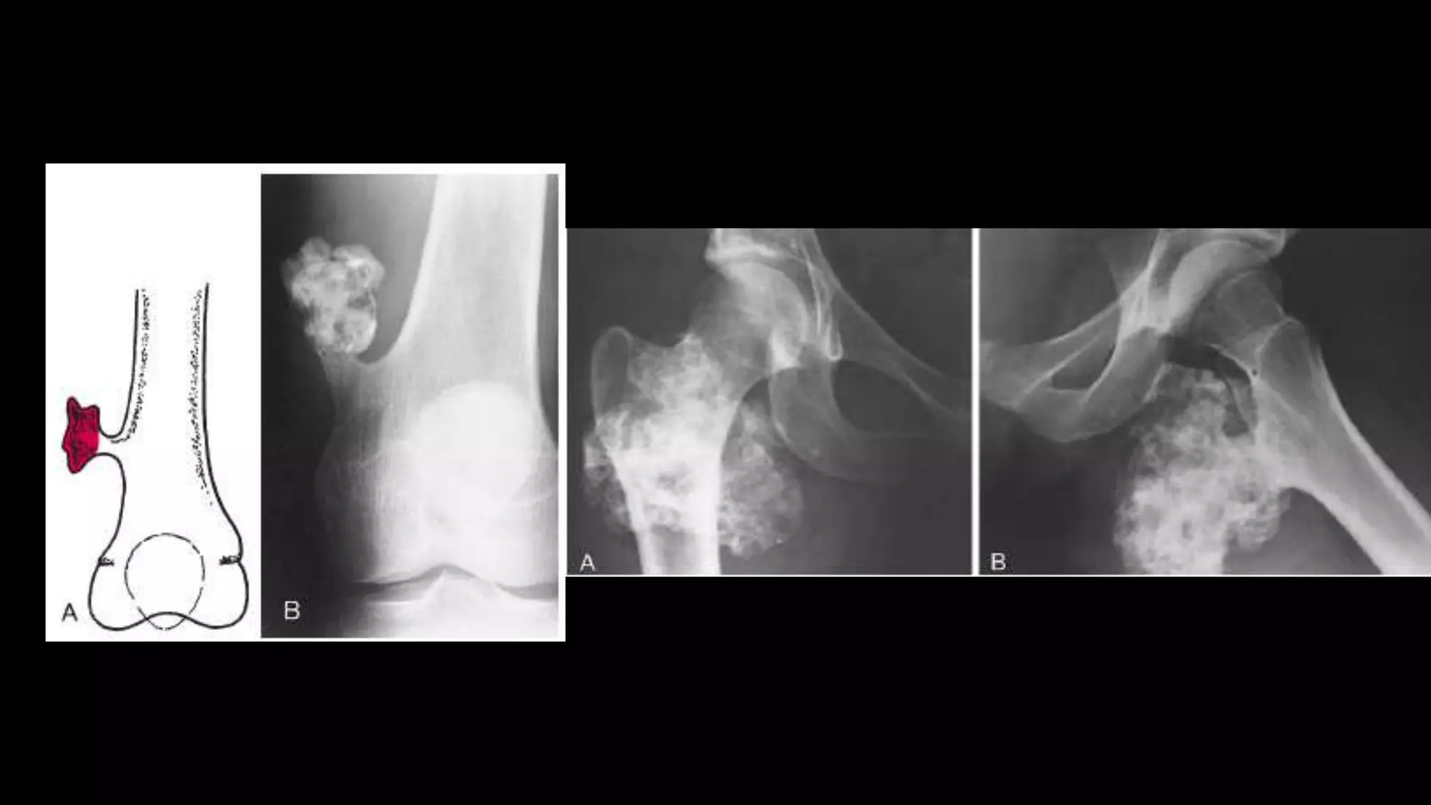 Imaging of benign bone tumors | PPTX