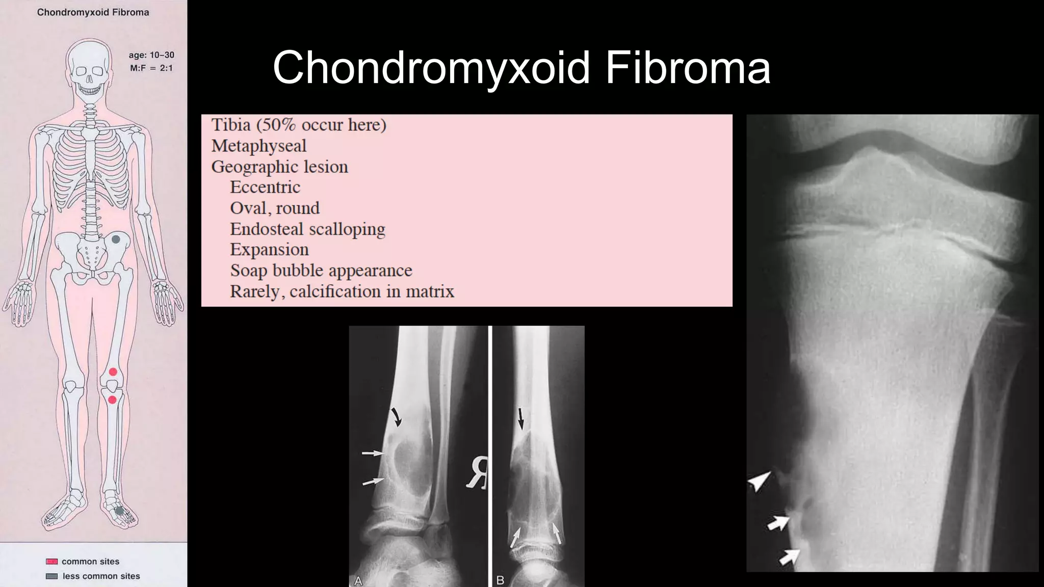 Imaging of benign bone tumors | PPTX