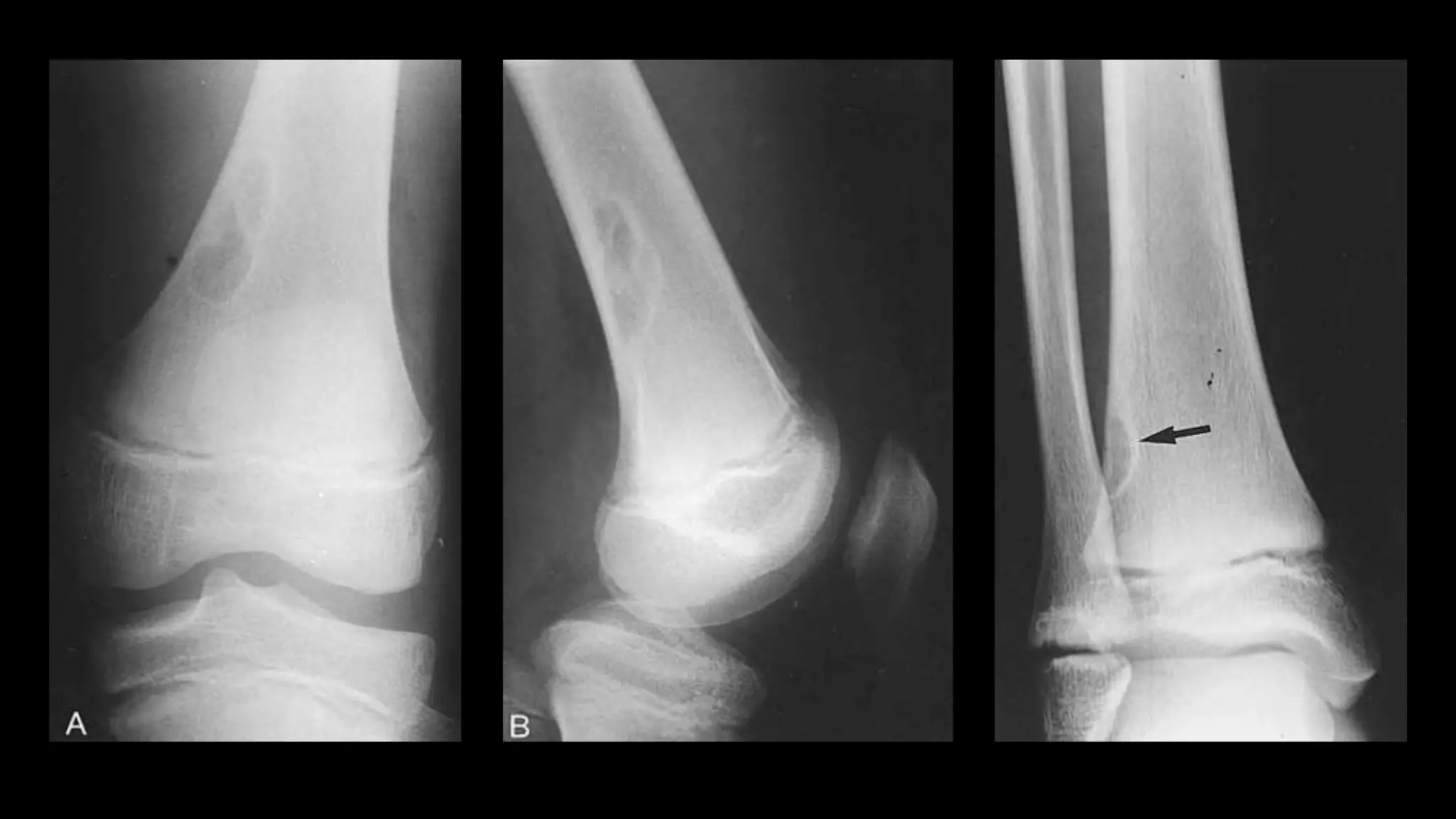 Imaging of benign bone tumors | PPTX