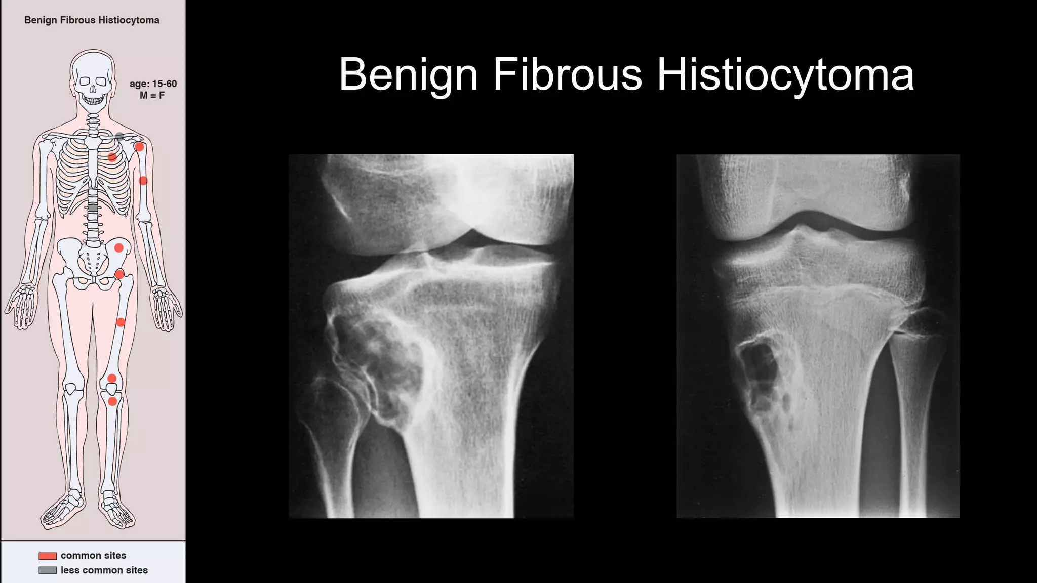 Imaging of benign bone tumors | PPTX