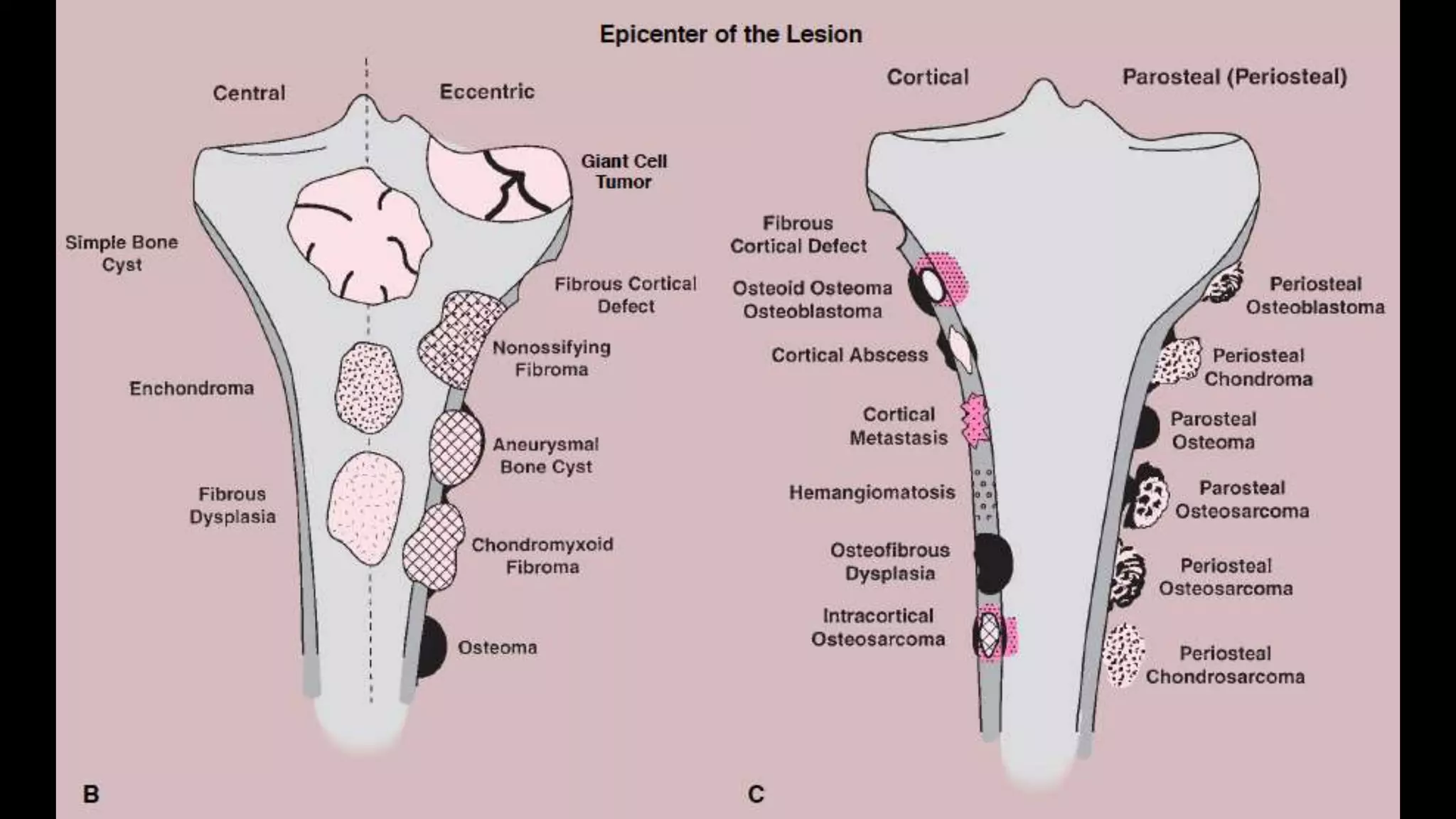 Imaging of benign bone tumors | PPTX