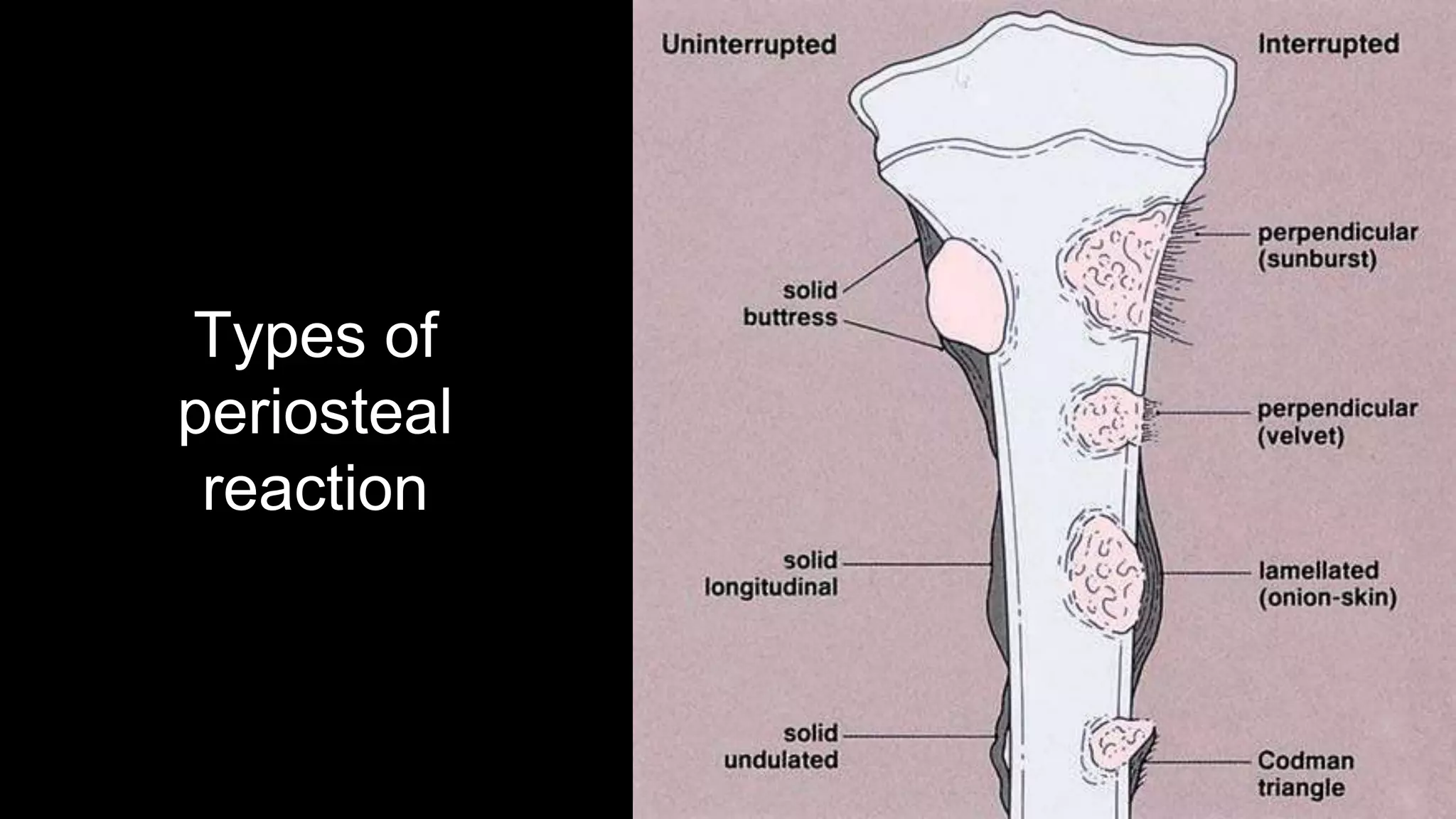 Imaging of benign bone tumors | PPTX