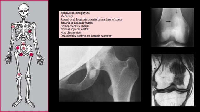 Imaging of benign bone tumors | PPTX