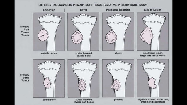Imaging of benign bone tumors | PPTX