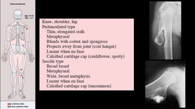 Imaging of benign bone tumors | PPTX