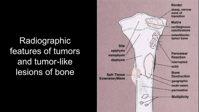 Imaging of benign bone tumors | PPTX
