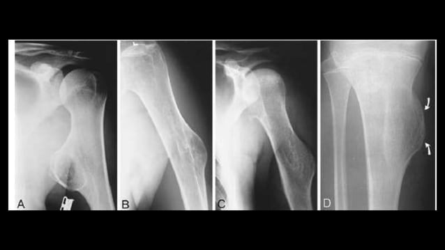 Imaging of benign bone tumors | PPTX