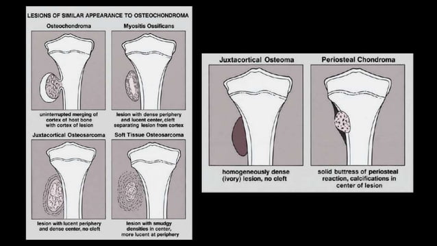 Imaging of benign bone tumors | PPTX