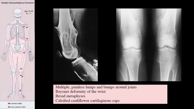 Imaging of benign bone tumors | PPTX