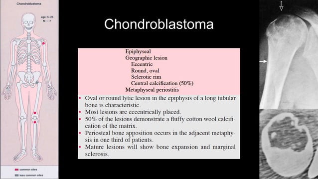 Imaging of benign bone tumors | PPTX