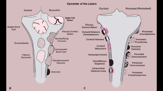 Imaging of benign bone tumors | PPTX