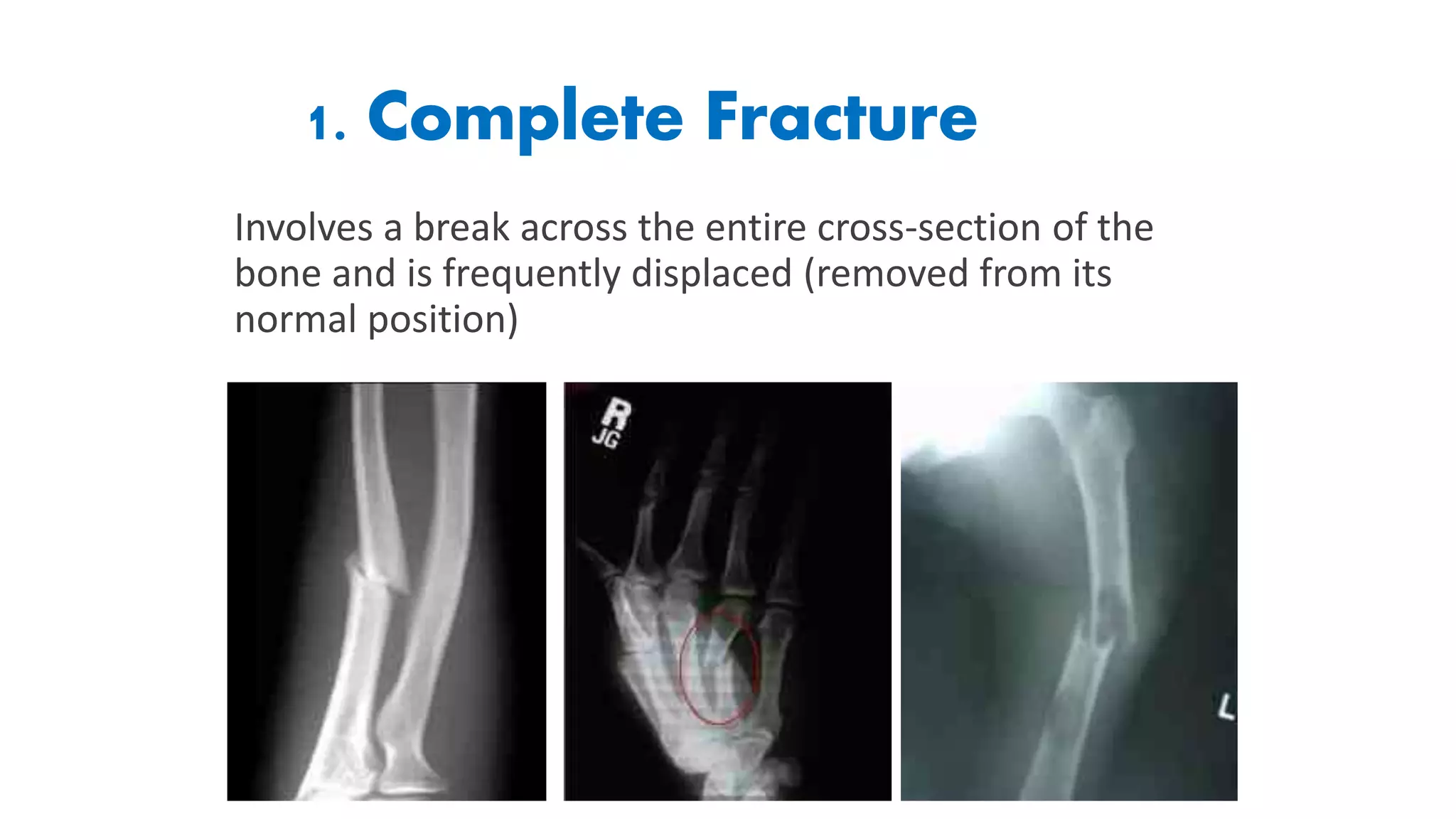 Musculoskeletal conditions, fractures | PPT