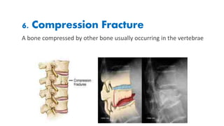 Musculoskeletal conditions, fractures | PPT