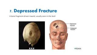 Musculoskeletal conditions, fractures | PPTX