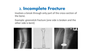 Musculoskeletal conditions, fractures | PPT