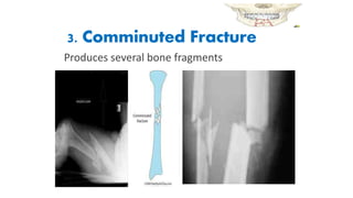 Musculoskeletal conditions, fractures | PPTX