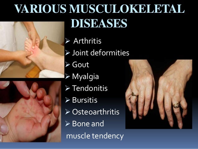 Austin Journal of Musculoskeletal Disorders