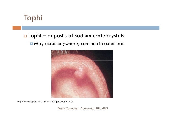 Osteoarthritis & Gouty Arthritis