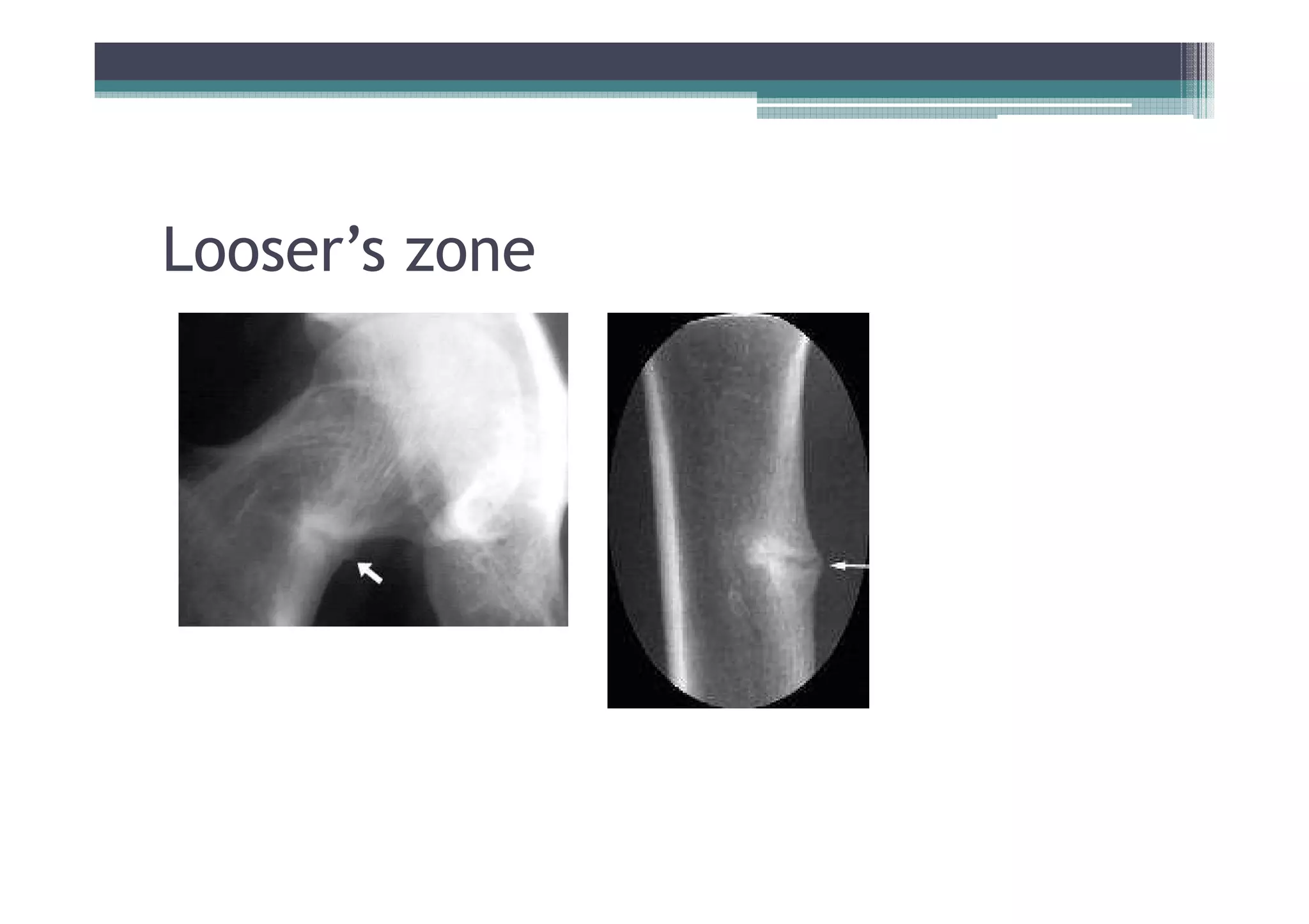 Osteoporosis, Osteomalacia, Paget's disease | PDF