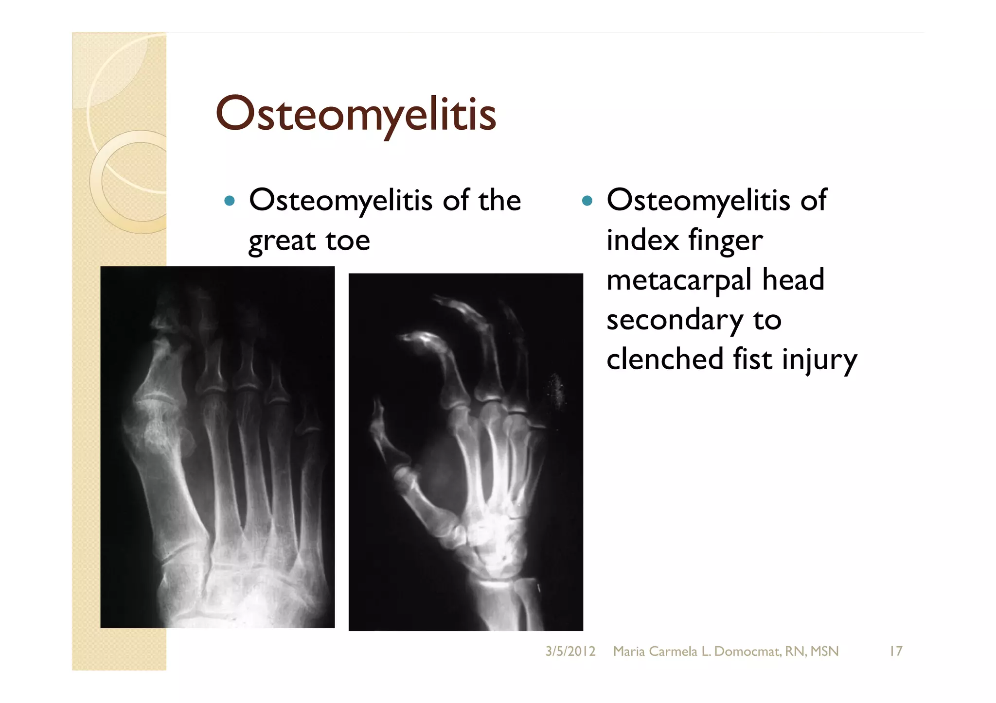 Bone and joint infections: Osteomyelitis, Septic Arthritis | PDF
