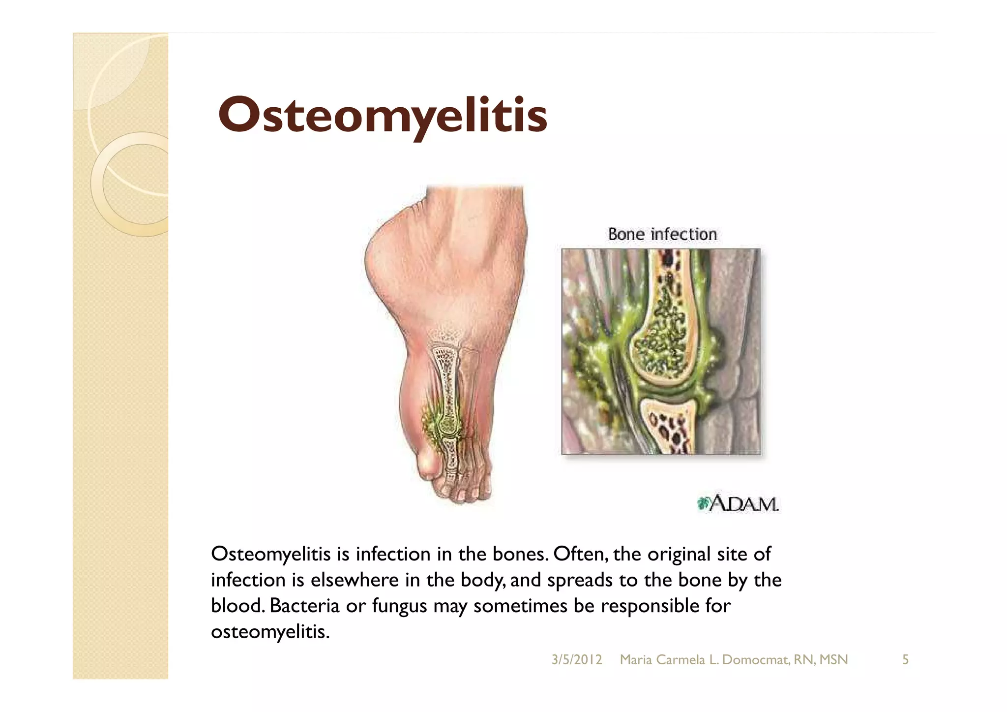 Bone and joint infections: Osteomyelitis, Septic Arthritis | PDF