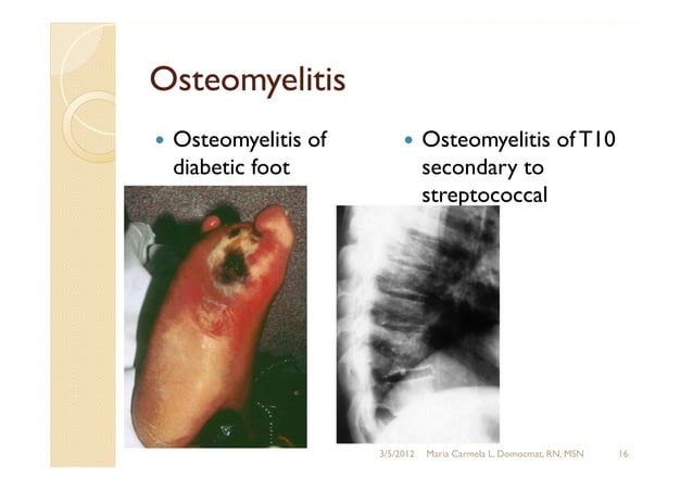 Bone and joint infections: Osteomyelitis, Septic Arthritis | PDF | Bone and Joint Conditions ...