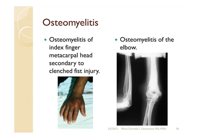 Bone and joint infections: Osteomyelitis, Septic Arthritis | PDF | Bone ...