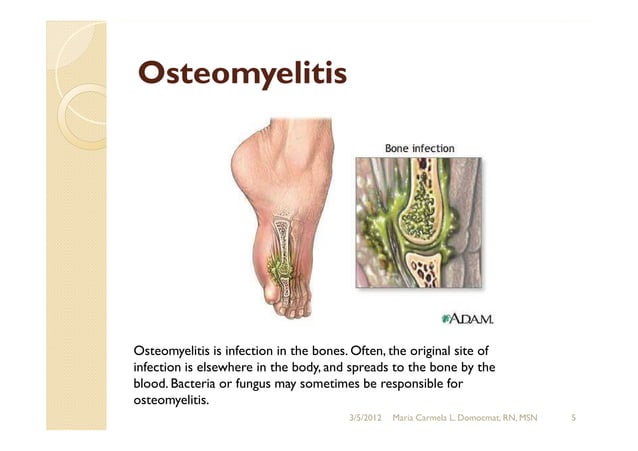Bone and joint infections: Osteomyelitis, Septic Arthritis | PDF | Bone ...