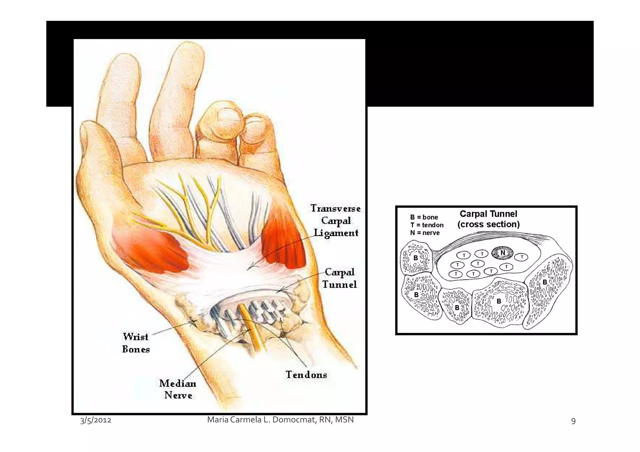 Musculoskeletal disorders Part 4 Disorders of the Hands: Carpal Tunnel ...