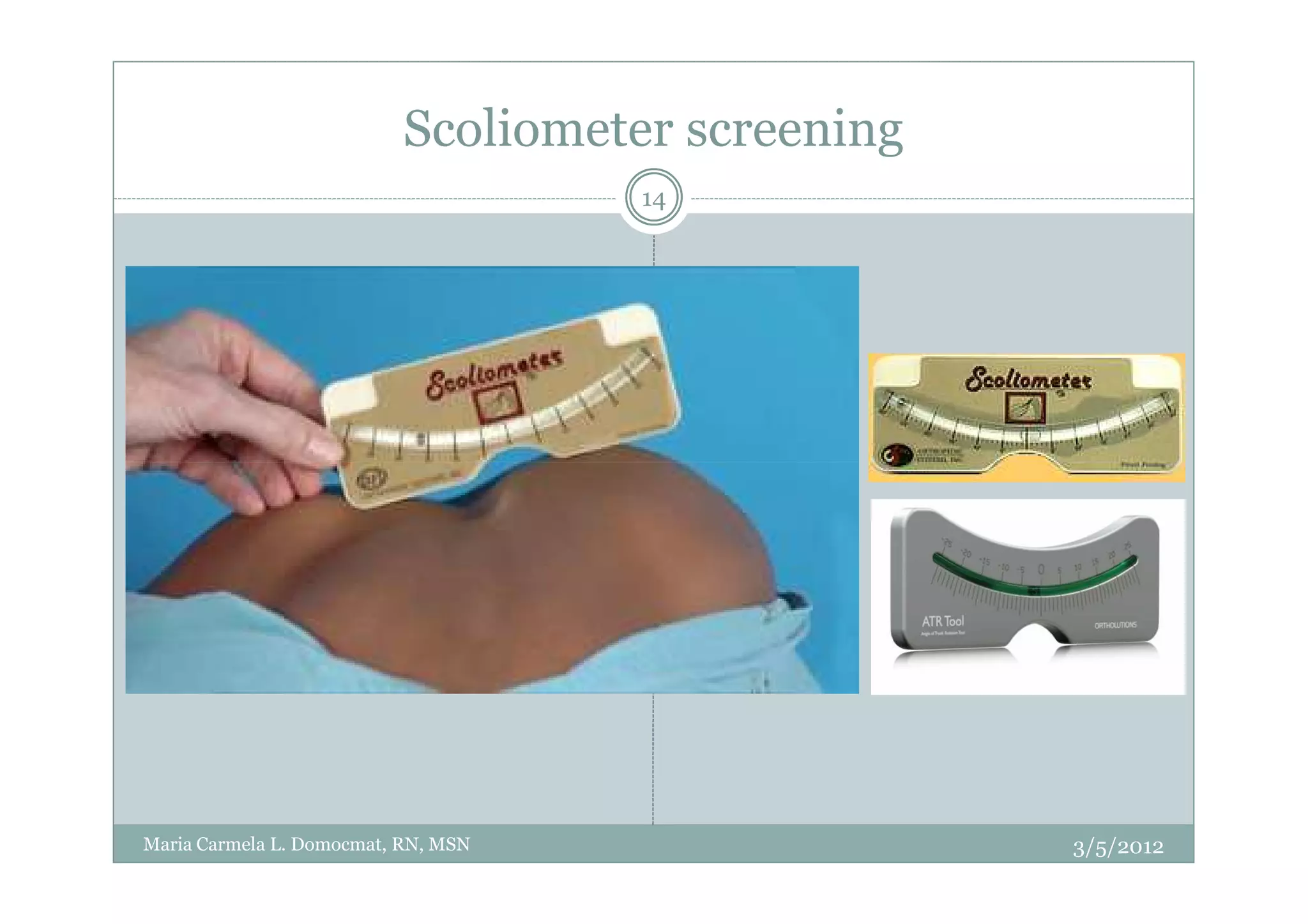 Spinal Column Deformities | PDF