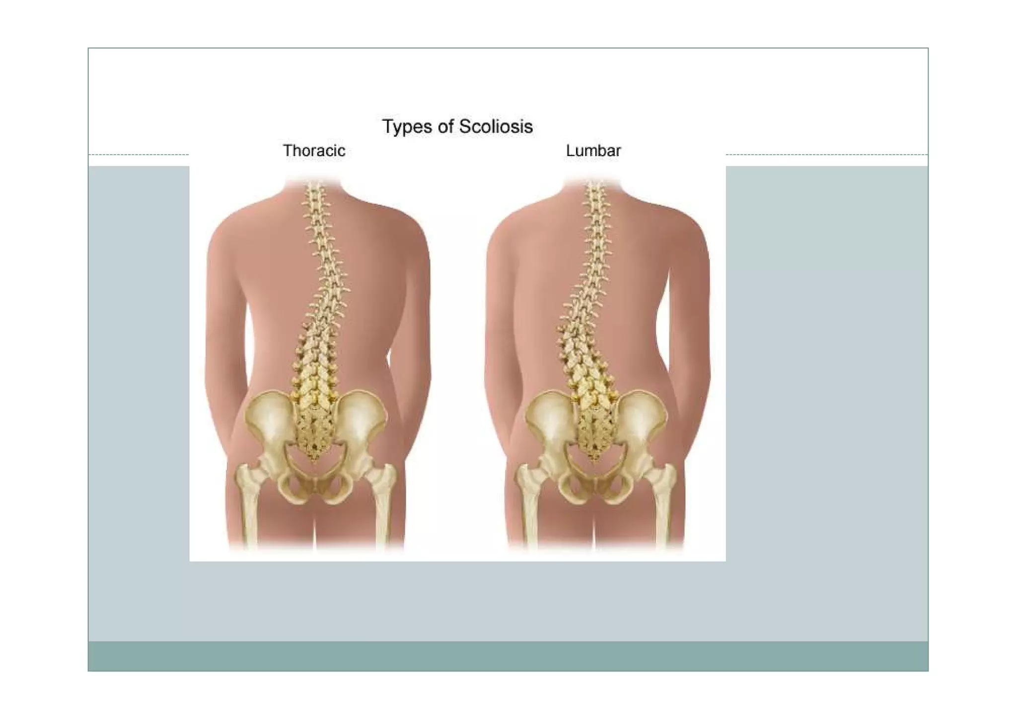 Spinal Column Deformities | PDF