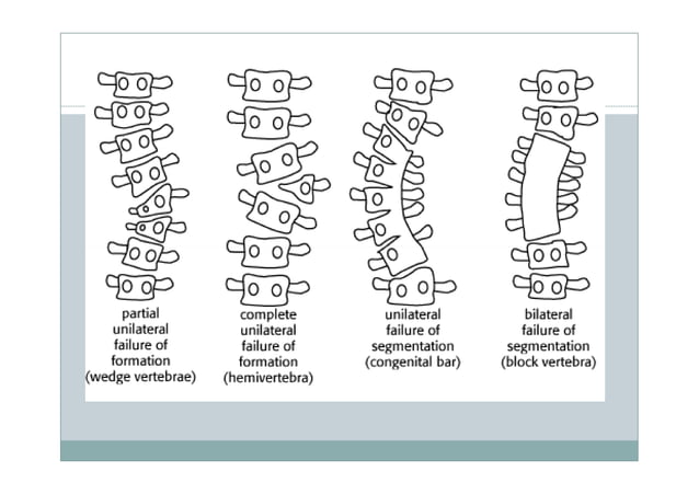Spinal Column Deformities | PDF