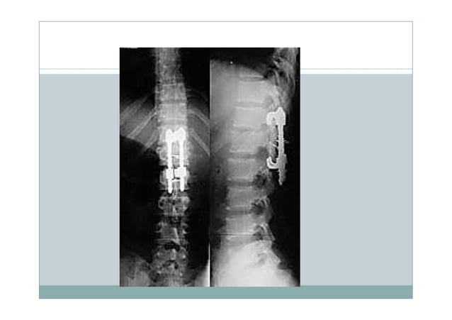 Spinal Column Deformities | PDF