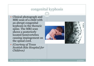 Spinal Column Deformities | PDF