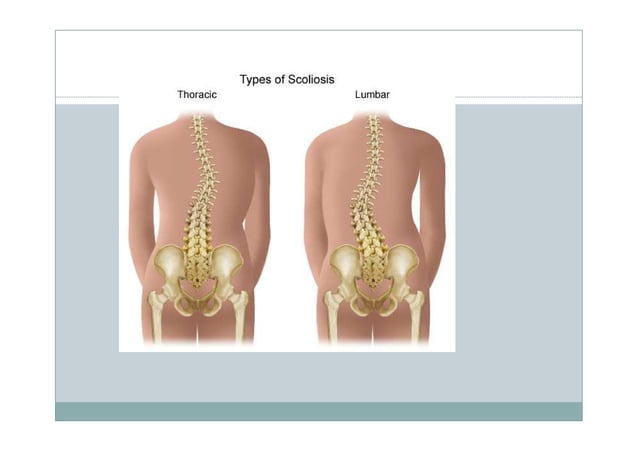 Spinal Column Deformities | PPT