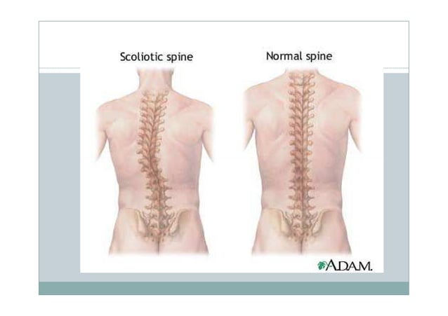 Spinal Column Deformities | PDF