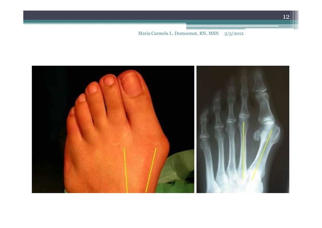 Musculoskeletal Disorders of the feet | PDF | Death, Injury, or ...