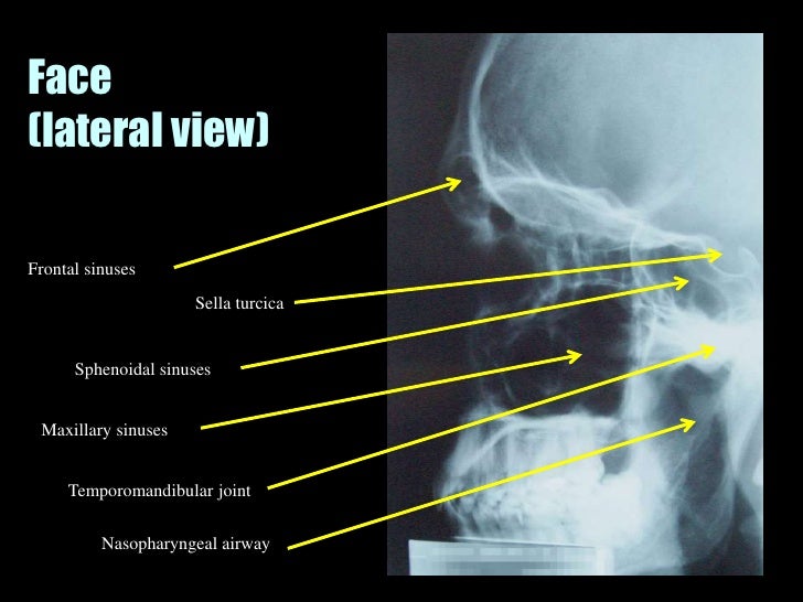 Frontal Sinus - New