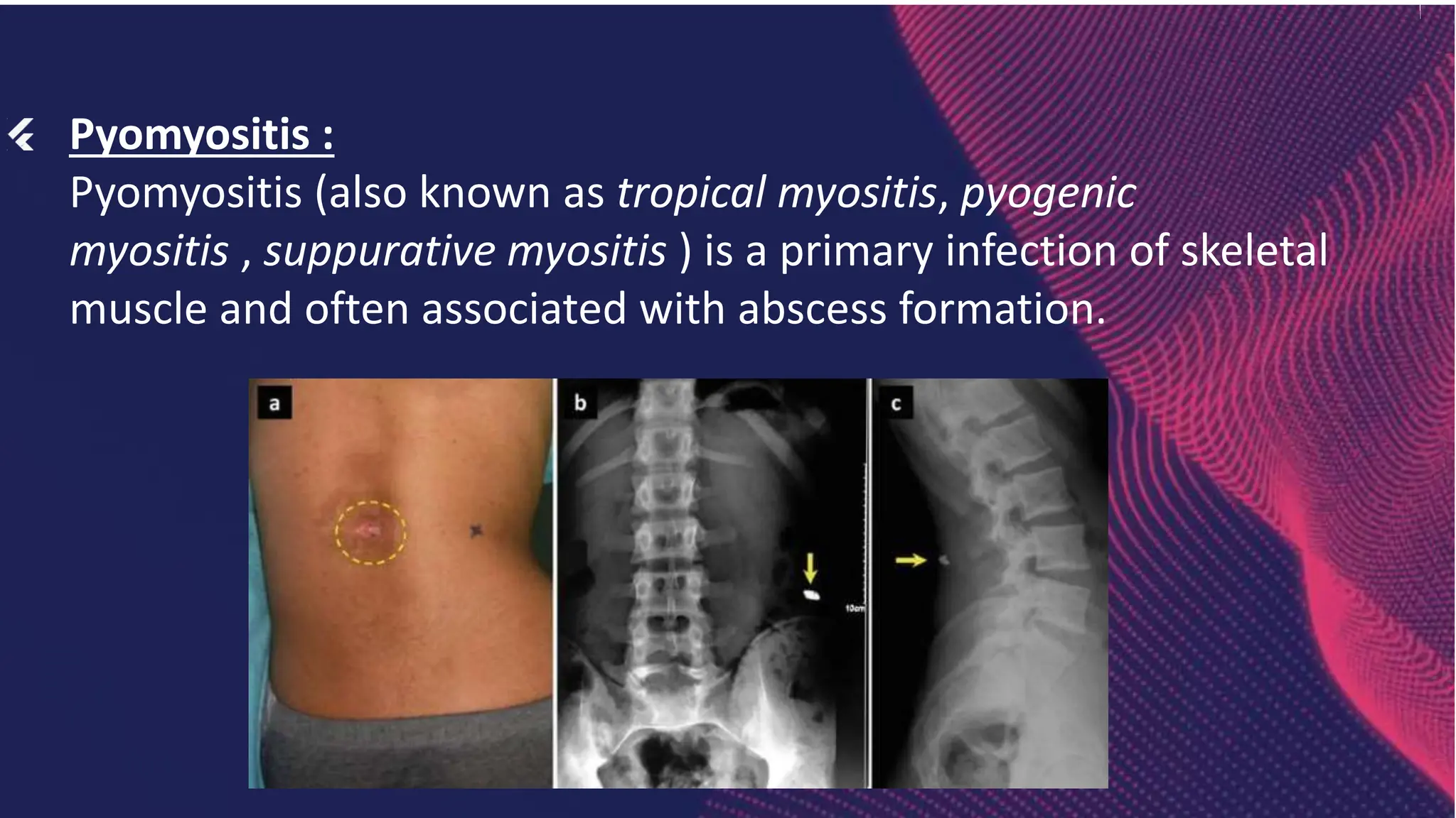 Musculoskeletal infection basics by capt alauddin.pptx