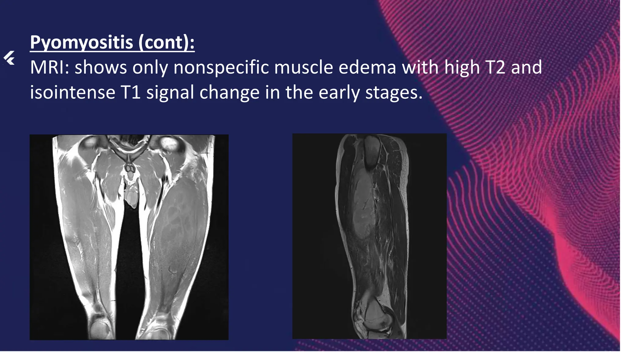 Musculoskeletal infection basics by capt alauddin.pptx