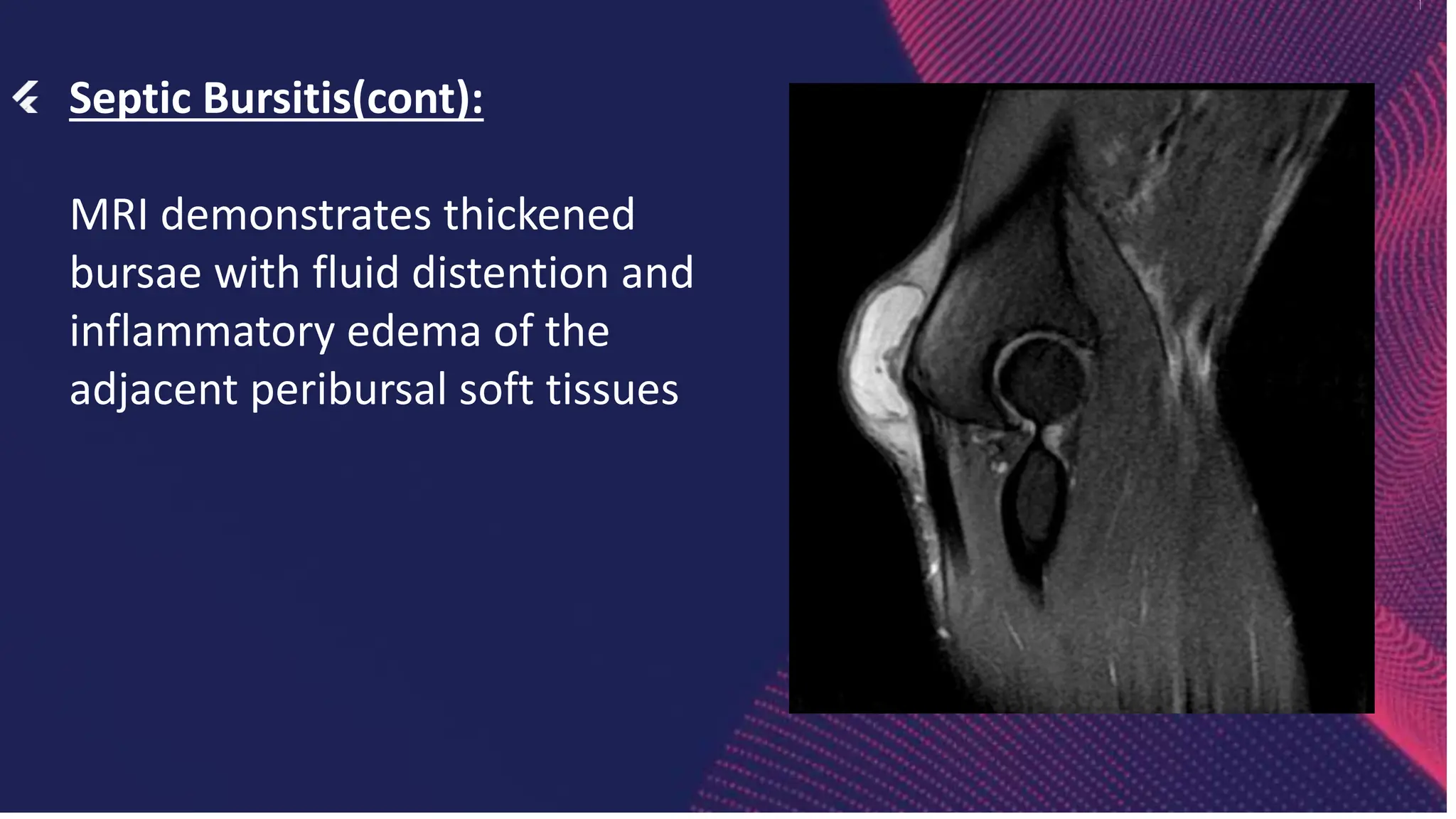 Musculoskeletal infection basics by capt alauddin.pptx