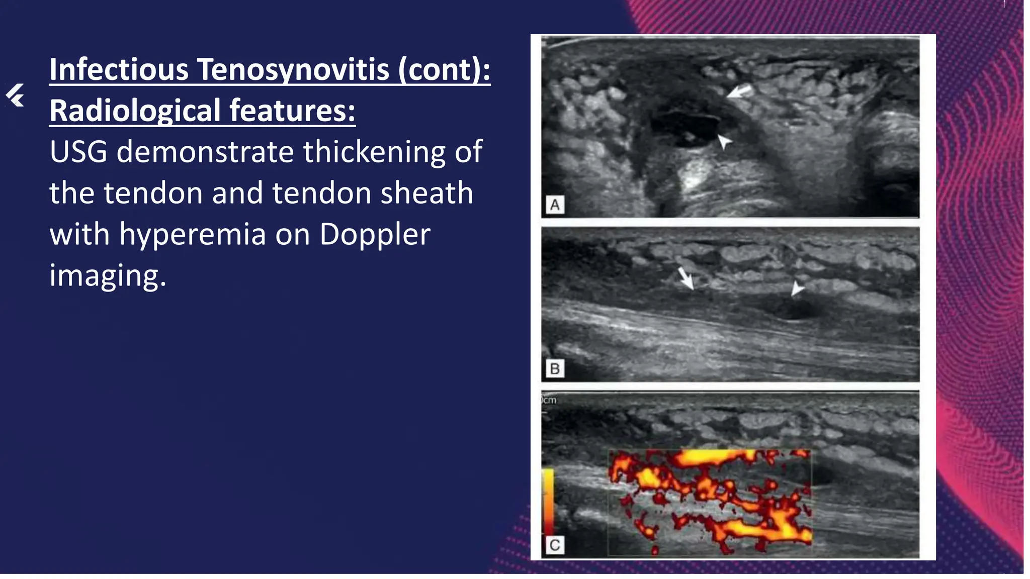 Musculoskeletal infection by capt alauddin.pptx